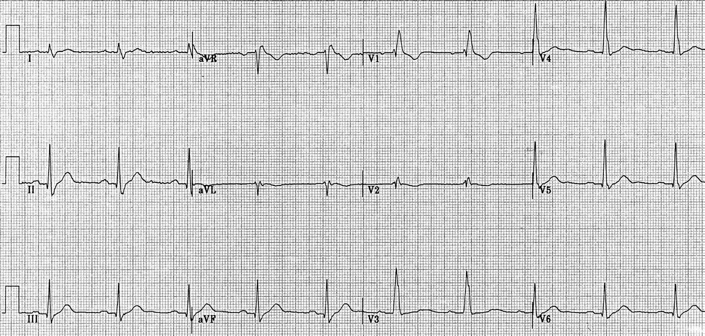 EKG Part 10 : Bradikardi – DIFUSI REVIEW