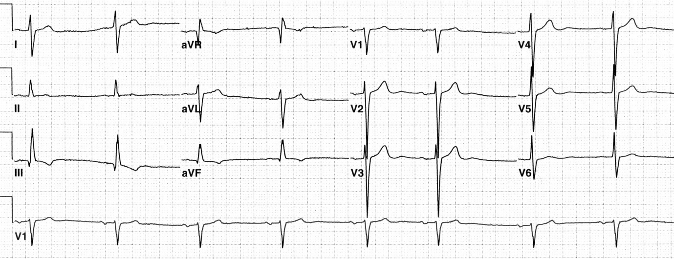 EKG Part 10 : Bradikardi – DIFUSI REVIEW