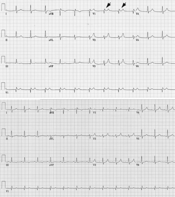 EKG Part 10 : Bradikardi – DIFUSI REVIEW