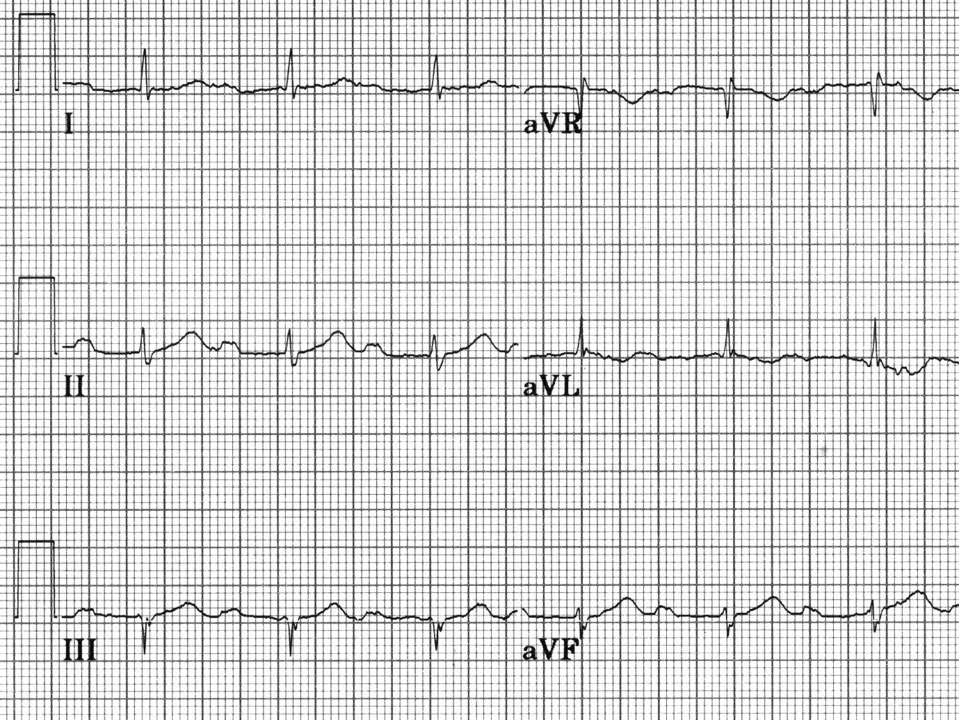 EKG Part 10 : Bradikardi – DIFUSI REVIEW