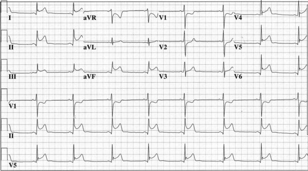 EKG Part 7 : Elevasi Segmen ST dan Penemuan Lain pada Infark Miokard ...