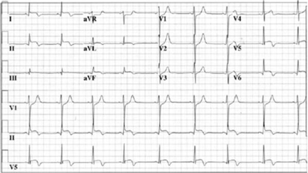 EKG Part 7 : Elevasi Segmen ST dan Penemuan Lain pada Infark Miokard ...