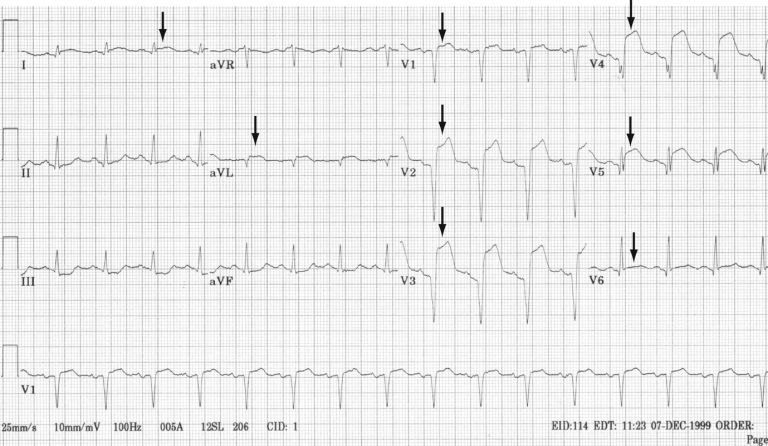 EKG Part 7 : Elevasi Segmen ST dan Penemuan Lain pada Infark Miokard ...