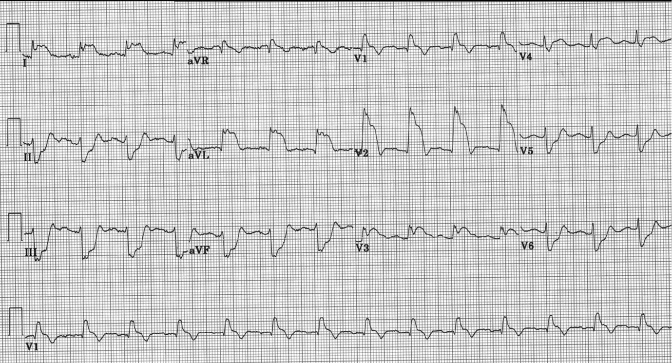 EKG Part 7 : Elevasi Segmen ST dan Penemuan Lain pada Infark Miokard ...