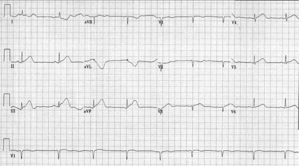 EKG Part 7 : Elevasi Segmen ST dan Penemuan Lain pada Infark Miokard ...