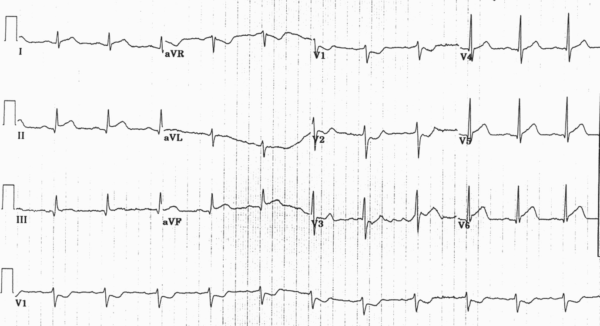 EKG Part 7 : Elevasi Segmen ST dan Penemuan Lain pada Infark Miokard ...