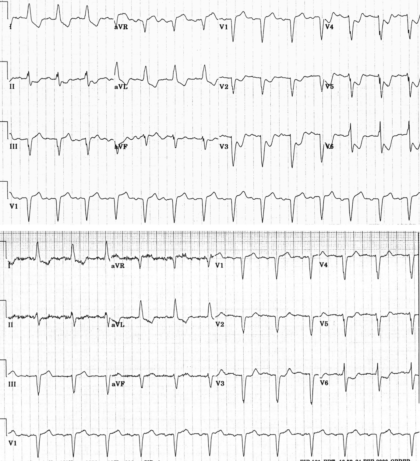EKG Part 7 : Elevasi Segmen ST dan Penemuan Lain pada Infark Miokard ...