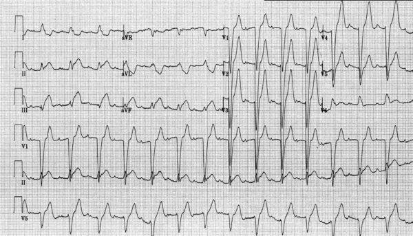 EKG Part 7 : Elevasi Segmen ST dan Penemuan Lain pada Infark Miokard ...
