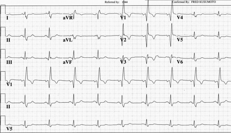 EKG Part 7 : Elevasi Segmen ST dan Penemuan Lain pada Infark Miokard ...