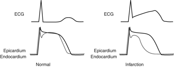 EKG Part 7 : Elevasi Segmen ST dan Penemuan Lain pada Infark Miokard ...