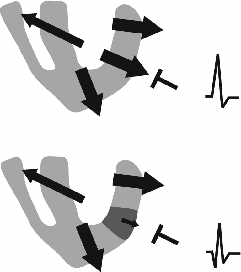 EKG Part 7 : Elevasi Segmen ST dan Penemuan Lain pada Infark Miokard ...