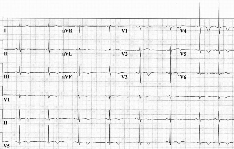 EKG Part 7 : Elevasi Segmen ST dan Penemuan Lain pada Infark Miokard ...