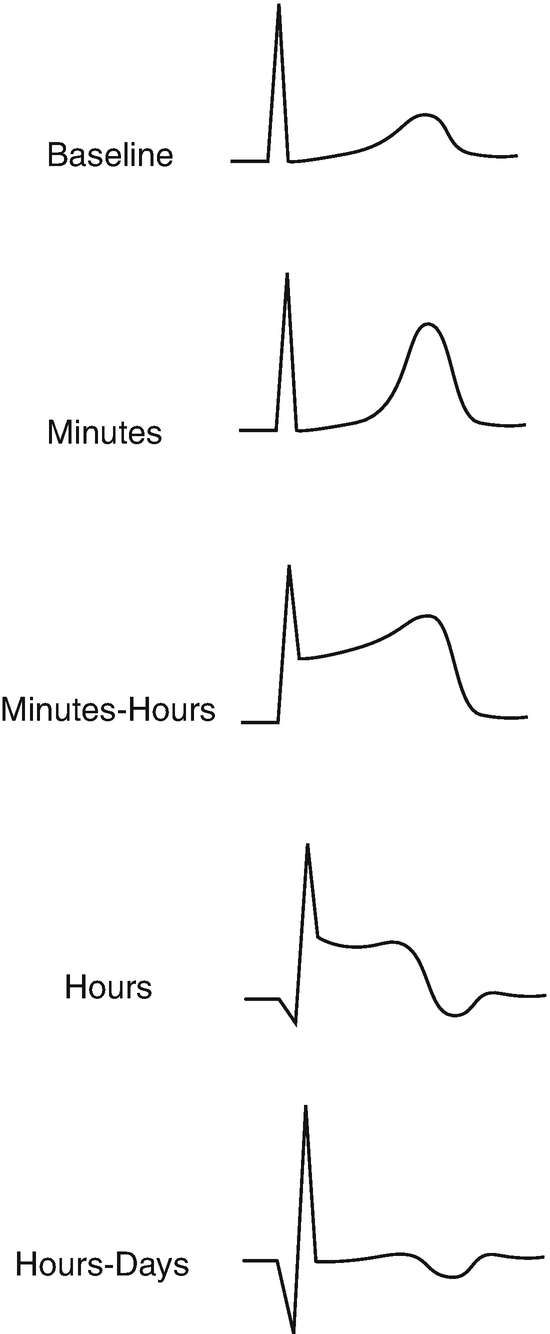 EKG Part 7 : Elevasi Segmen ST dan Penemuan Lain pada Infark Miokard ...
