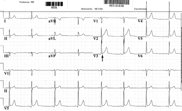 EKG Part 8 : ST Elevasi bukan karena Infark Miokard – DIFUSI REVIEW