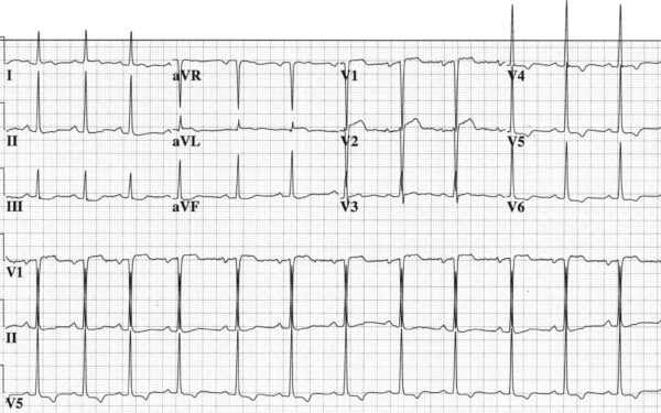 EKG Part 8 : ST Elevasi bukan karena Infark Miokard – DIFUSI REVIEW