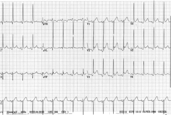 EKG Part 8 : ST Elevasi bukan karena Infark Miokard – DIFUSI REVIEW
